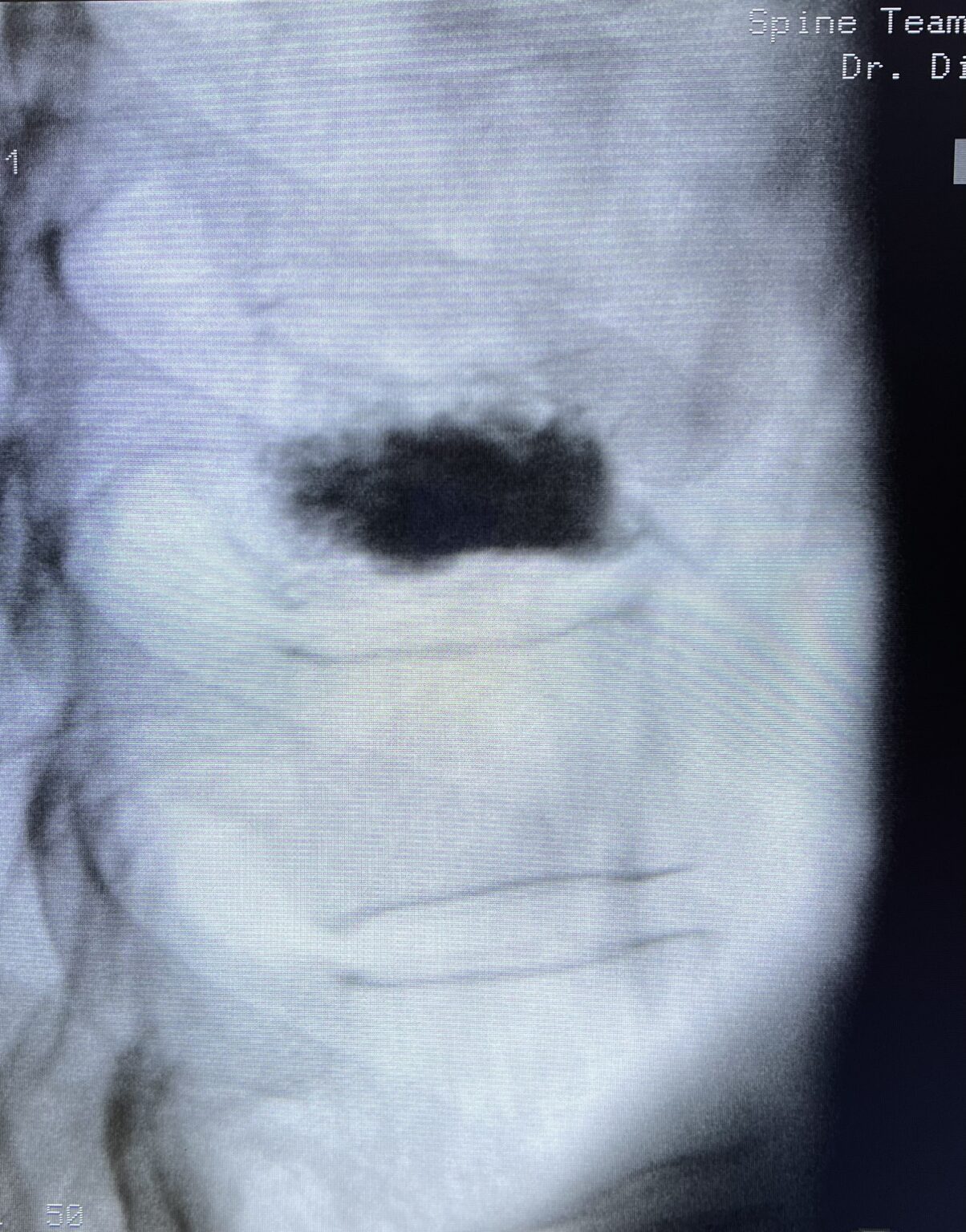 Kyphoplasty in Spokane for Spine Fractures | Spine Team